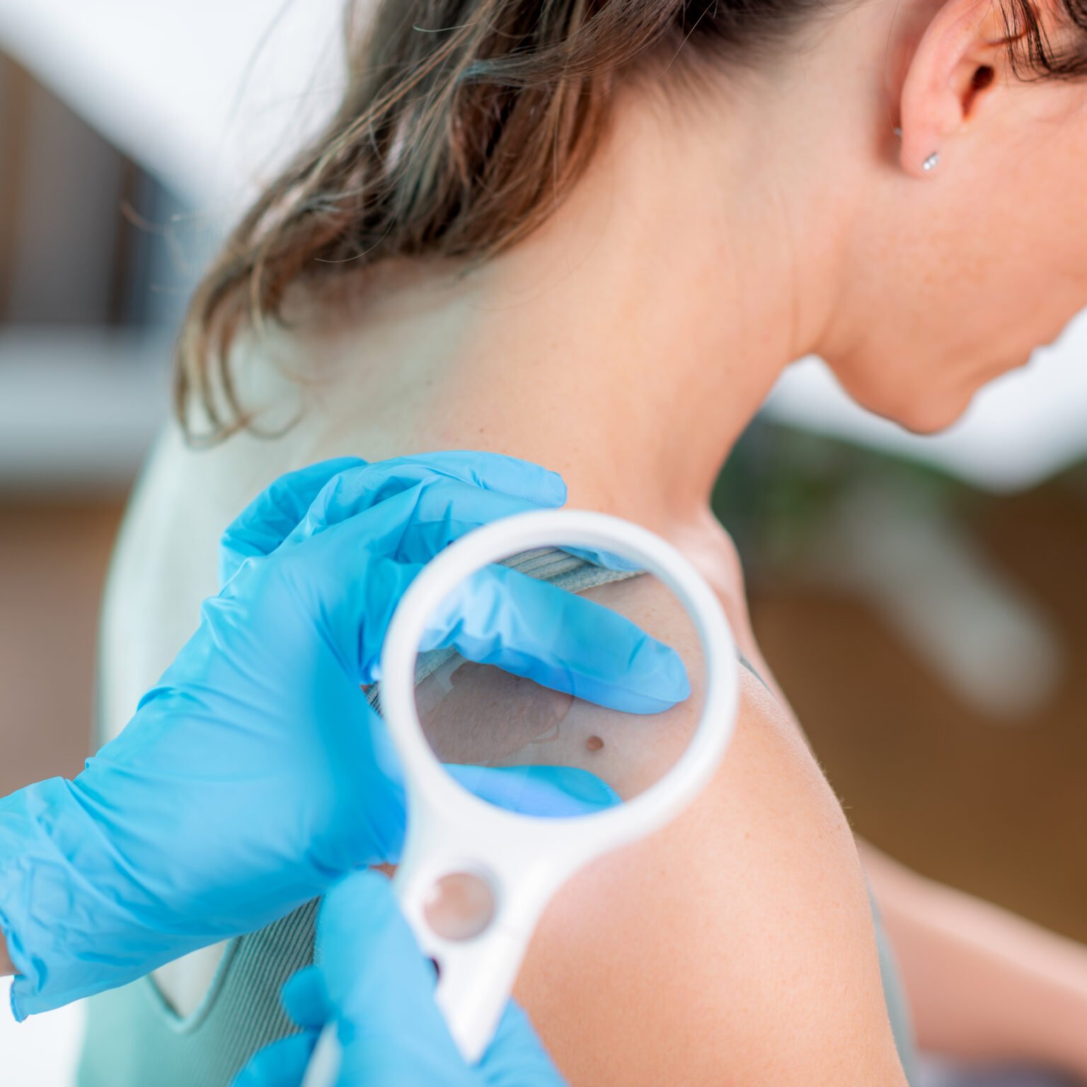 Revisión & Extracción de Lunares - Piel Perfecta Dermatología